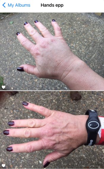 Erythropoietic Proto Porphyria (EPP) - Debbie Flint